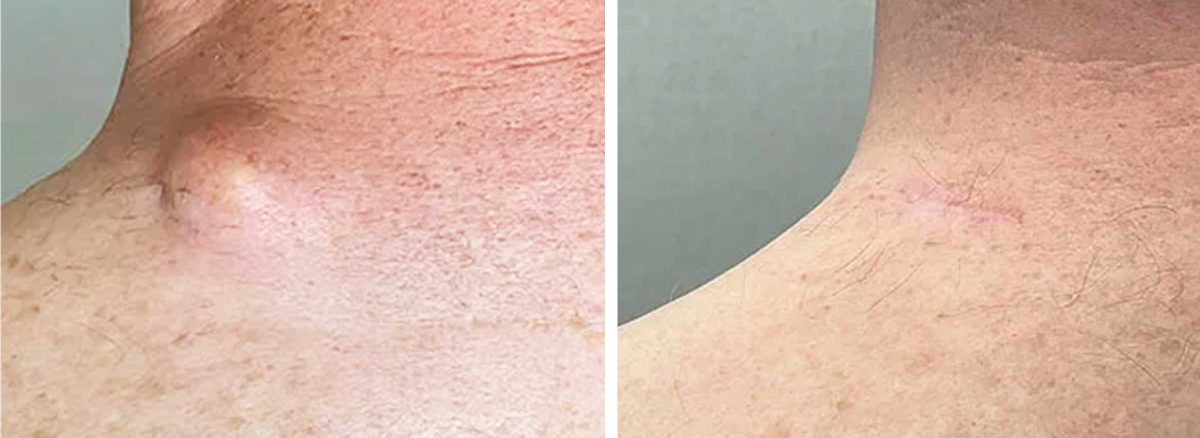 Cyst Removal - London, Harley Street